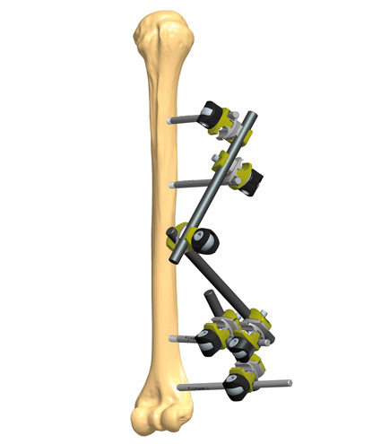 1E5 for Fractures - Orthofix