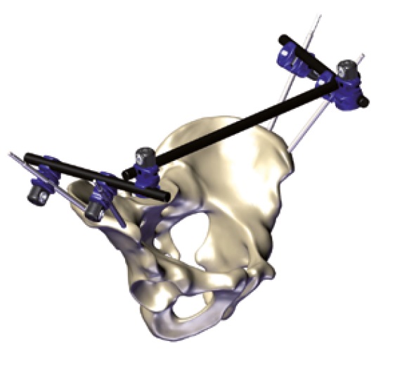 2A9 for Fractures and disruptions - Orthofix