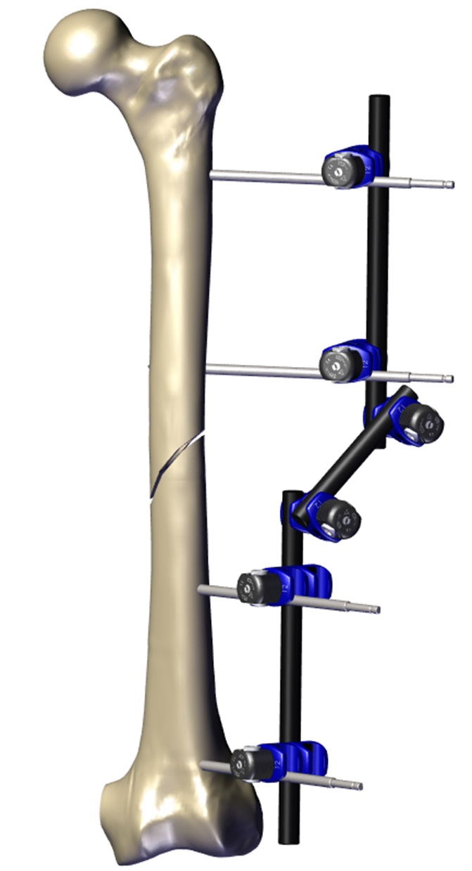 3A55 for Fractures - Orthofix