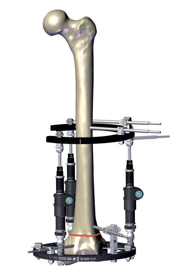 3A57 for Fractures - Orthofix