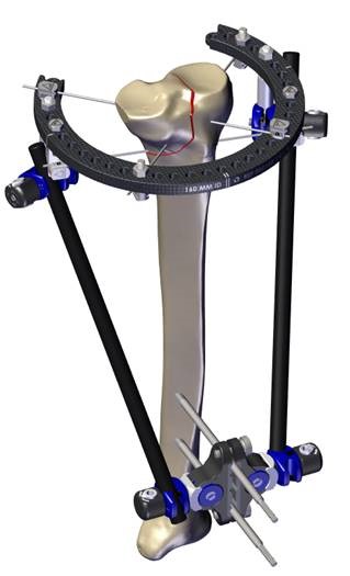 3B35 for Fractures - Orthofix