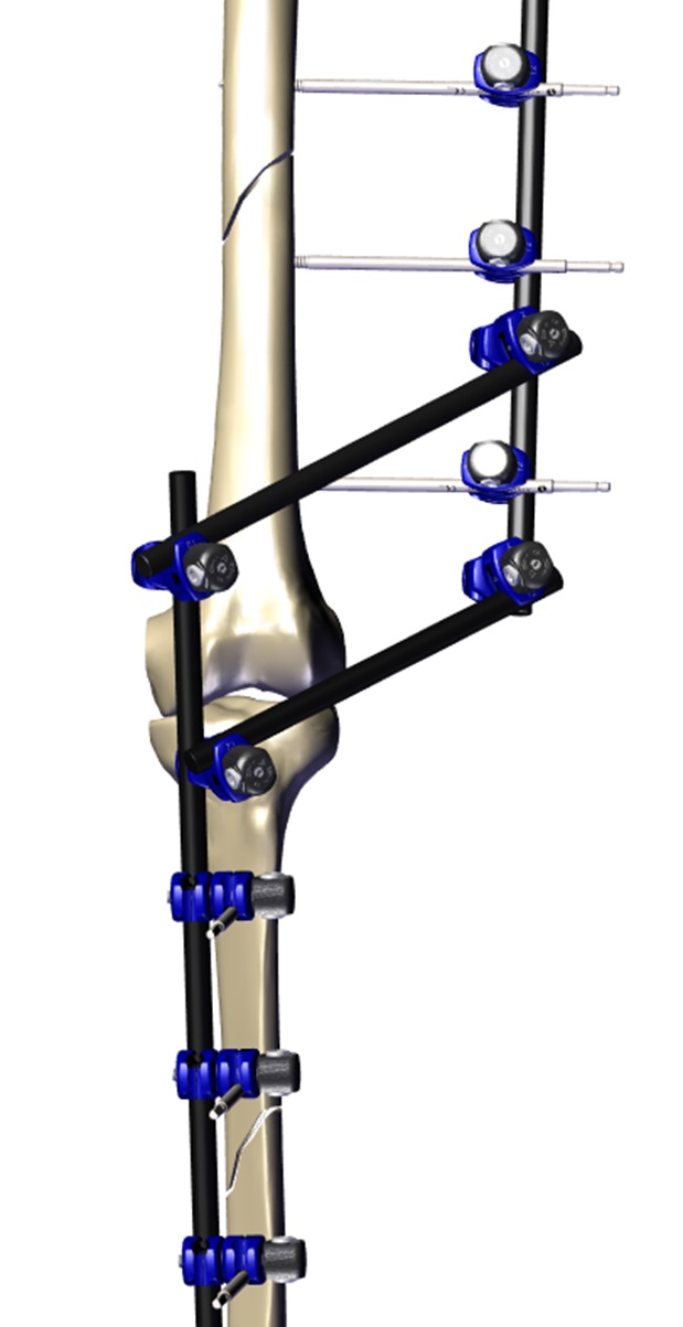 3B37 for Fractures - Orthofix