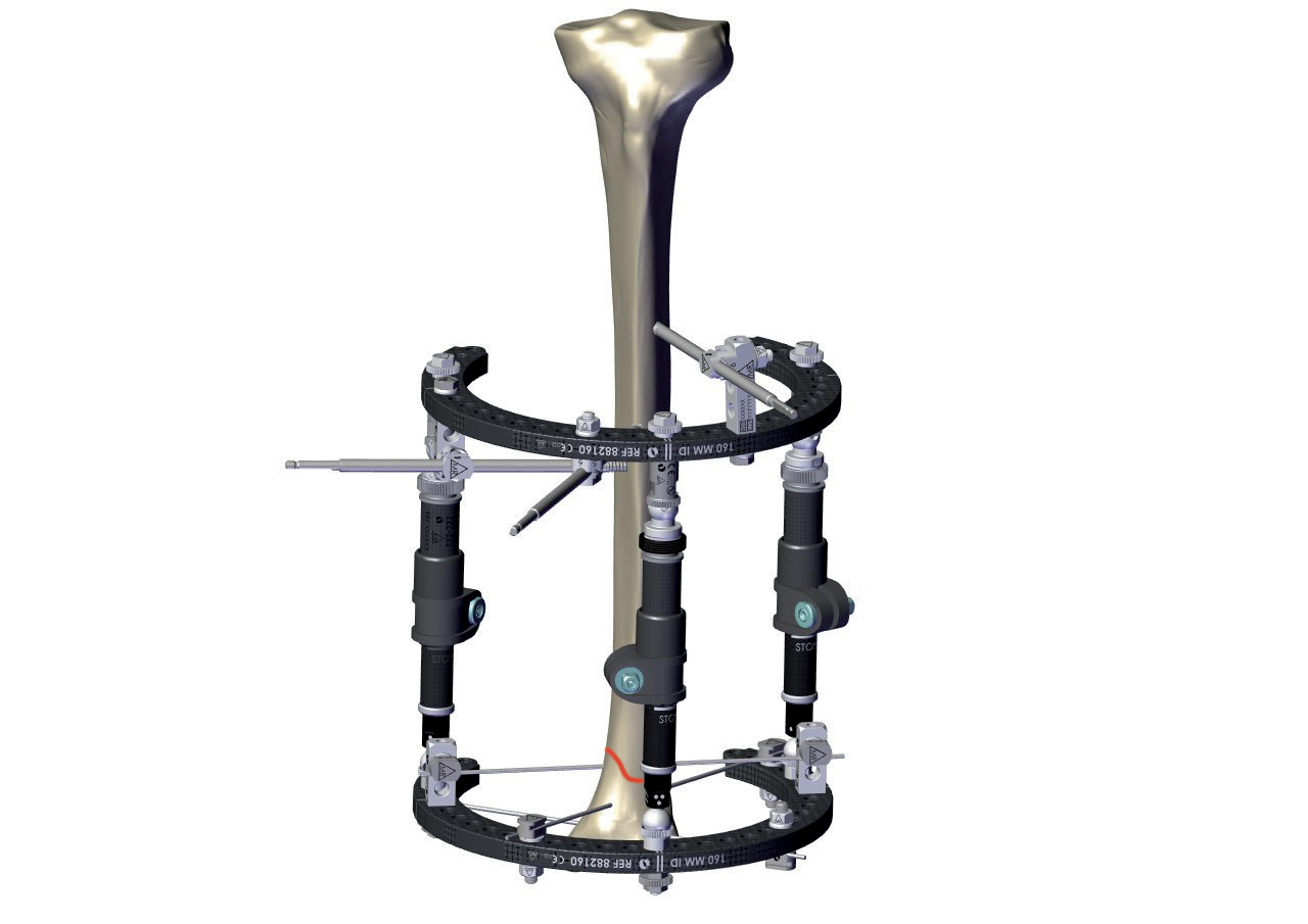 3C60 for Fractures - Orthofix