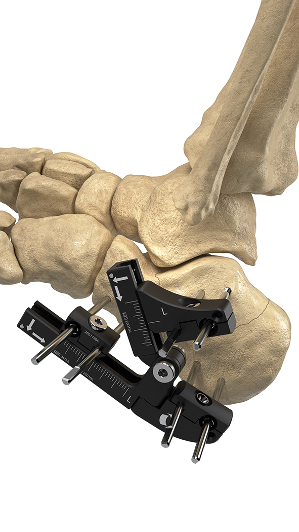 3E1 for Fractures - Orthofix