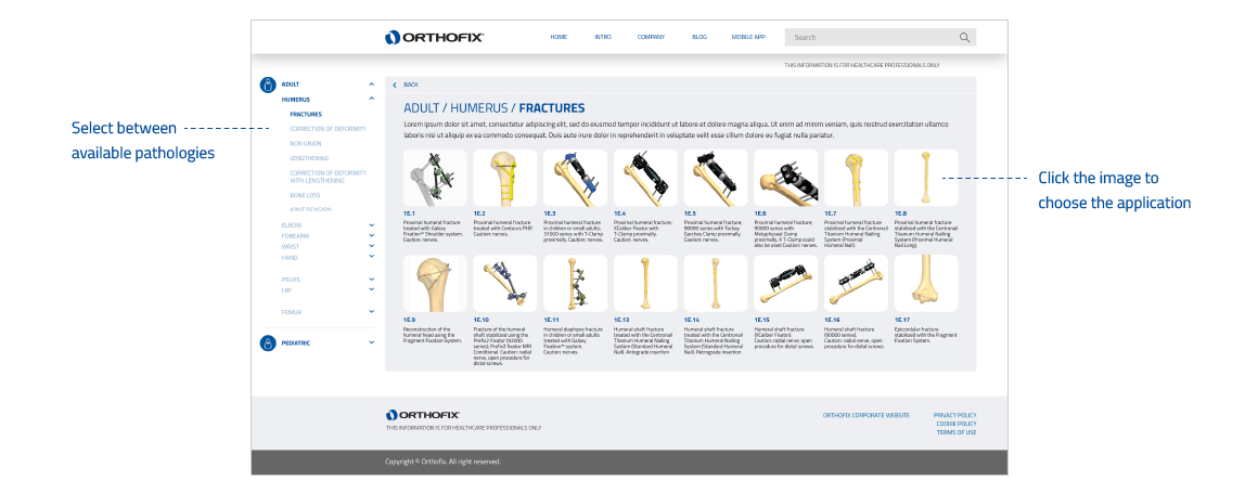 What is Orthofix ABS? - Orthofix