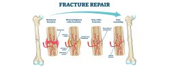 Bone healing and the role of external fixation - Orthofix