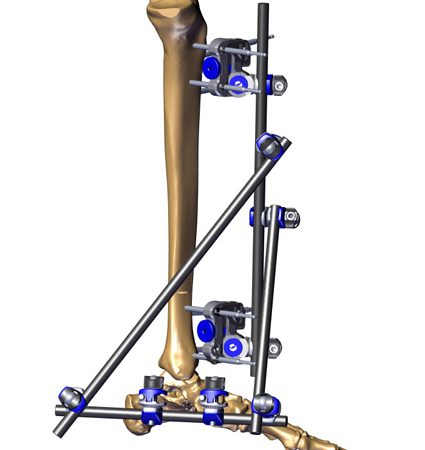 Ankle fracture recovery | Orthofix ABS