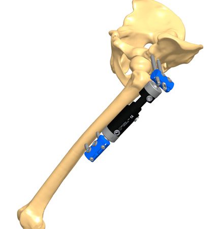 Pediatric hip fusion recovery | Orthofix ABS