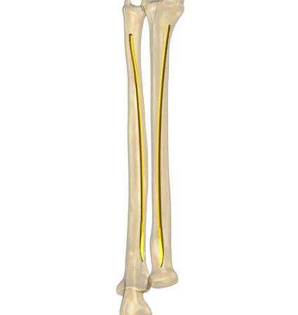 Pediatric treatments for forearm fracture | Orthofix ABS