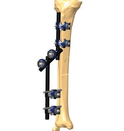 Tibia bone fracture treatment | Orthofix ABS
