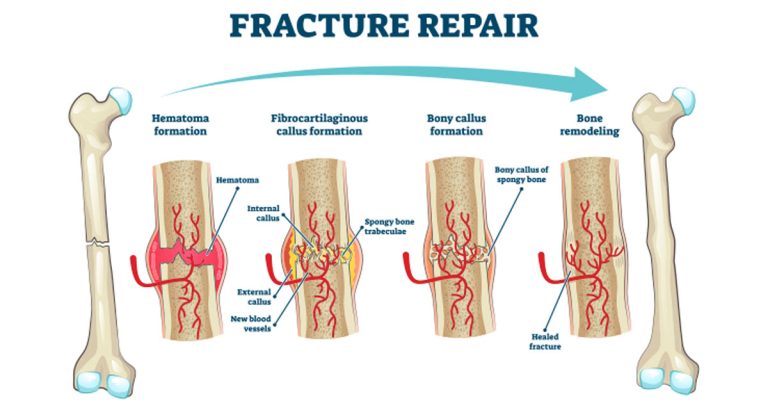 Bone Healing and the role of external fixation - Orthofix