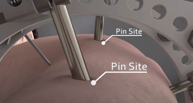 Key points for healthy Pin Sites - Orthofix