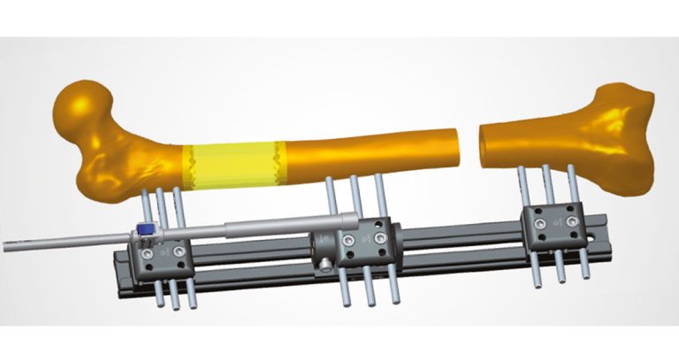 The Bone Transport Technique - Orthofix