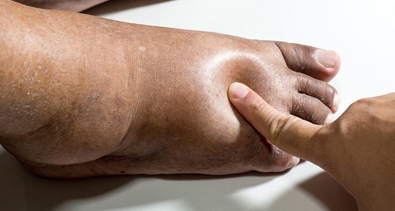 Charcot Foot and Ankle Treatment: surgical approach - Orthofix