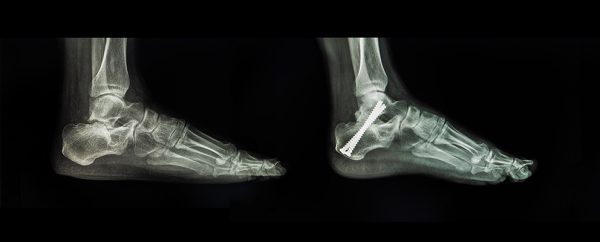 What is Arthrodesis also known as Joint Fusion? - Orthofix