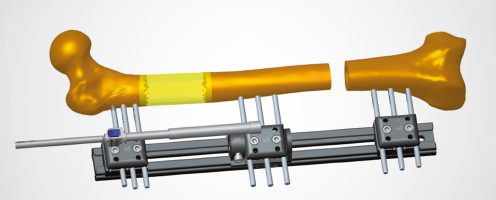 The Bone Transport Technique - Orthofix