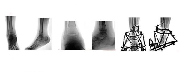 Internal Fixation vs External Fixation - Orthofix