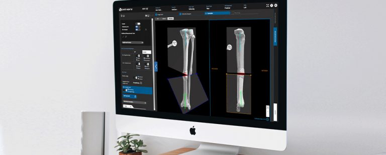 CORA (Center Of Rotation of Angulation) - Orthofix