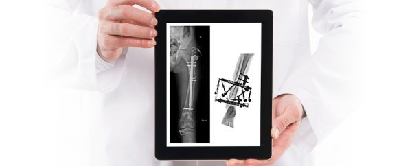 Internal Fixation vs External Fixation - Orthofix