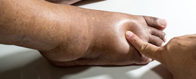 Charcot Foot and Ankle Disease: a quick diagnosis - Orthofix