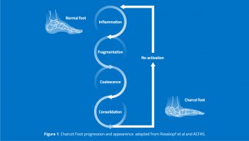 Charcot Foot and Ankle Definition and Classification - Orthofix
