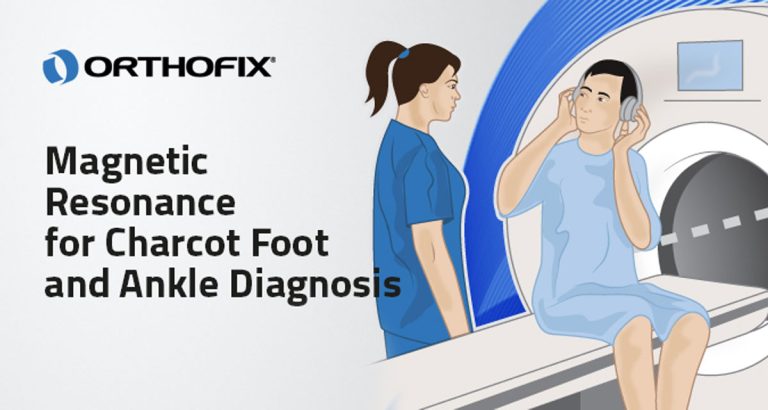 Charcot Foot and Ankle Definition and Classification - Orthofix