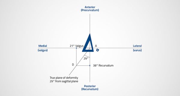 Calculation of the True Plane of the Deformity - Orthofix