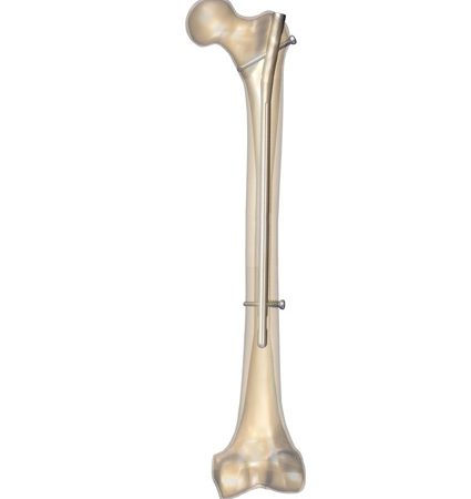 Correction of pediatric femur deformity | Orthofix ABS