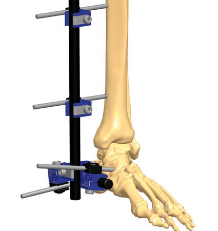 Ankle fracture recovery | Orthofix ABS
