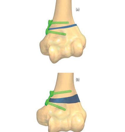Pediatric correction of elbow deformity | Orthofix ABS