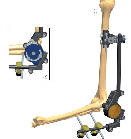Elbow fracture or dislocation treatments | Orthofix ABS