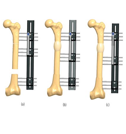 Femur bone loss recovery | Orthofix ABS