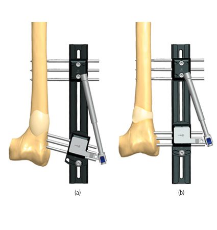 Correction of femur deformity following lengthening | Orthofix ABS