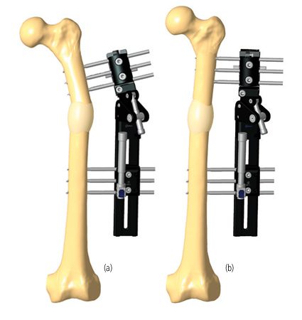Correction of femur deformity following lengthening | Orthofix ABS