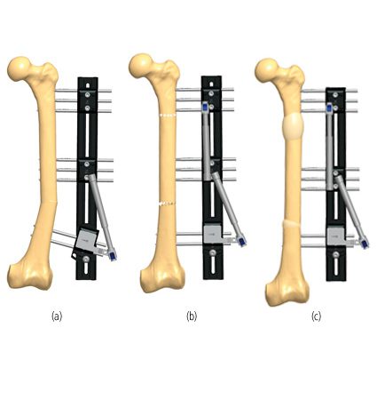 Correction of femur deformity with lengthening | Orthofix ABS