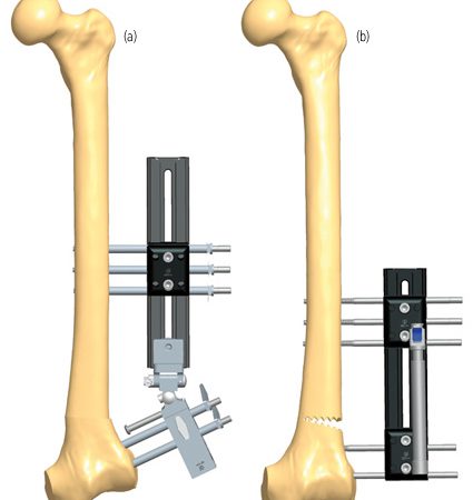 Correction of pediatric femur deformity | Orthofix ABS