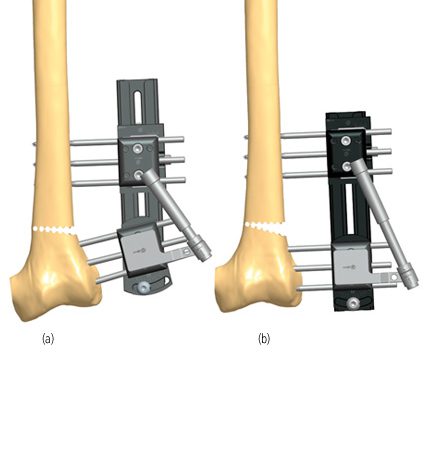 Correction of femur deformity | Orthofix ABS
