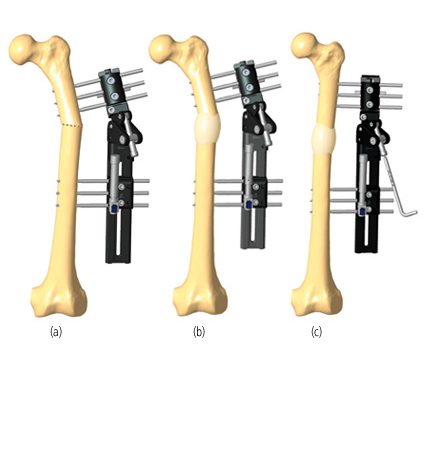 Correction of femur deformity | Orthofix ABS