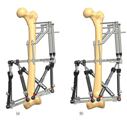 Correction of femur deformity | Orthofix ABS