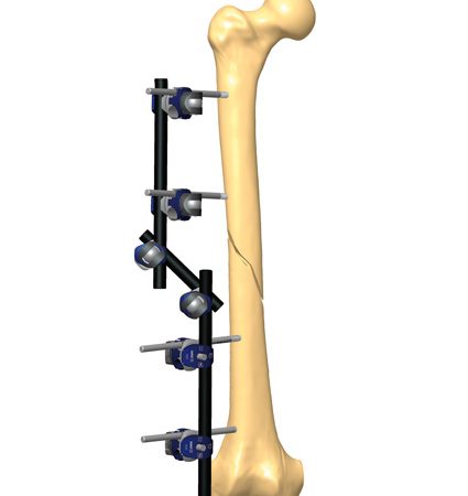 Femur fracture recovery | Orthofix ABS