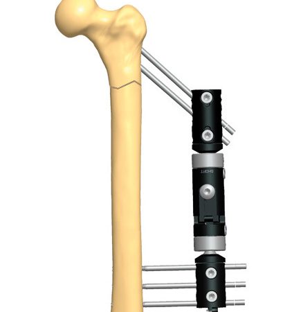 Femur fracture recovery | Orthofix ABS