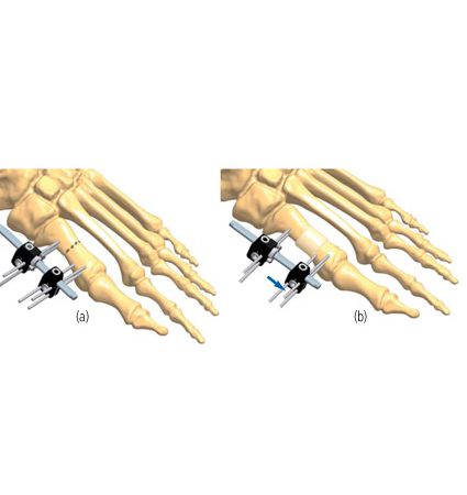 Foot lengthening treatment | Orthofix ABS