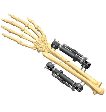 Forearm fracture treatments | Orthofix ABS