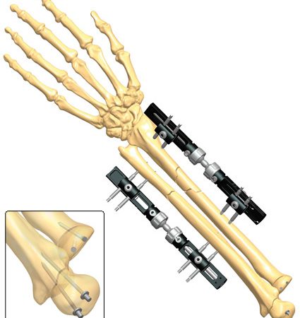 Forearm fracture treatments | Orthofix ABS