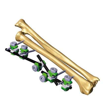 Pediatric treatments for forearm fracture | Orthofix ABS