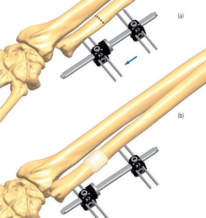 Forearm lengthening treatments | Orthofix ABS