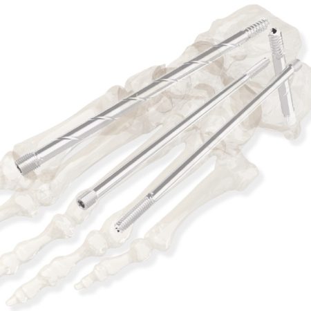 Ankle fusion recovery | Orthofix ABS