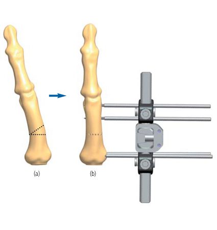 Hand bone deformity correction | Orthofix ABS