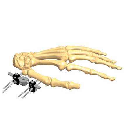Hand bone fracture treatments | Orthofix ABS