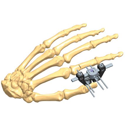 Hand bone fracture treatments | Orthofix ABS